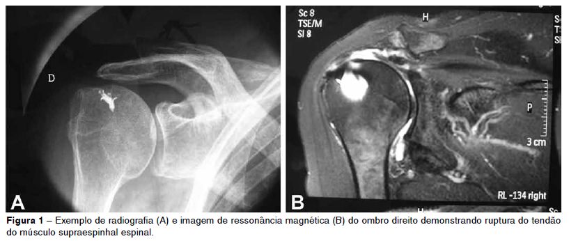 Tendinopatia do Manguito Rotador: dor no ombro | Clínica Dr. Hong Jin ...