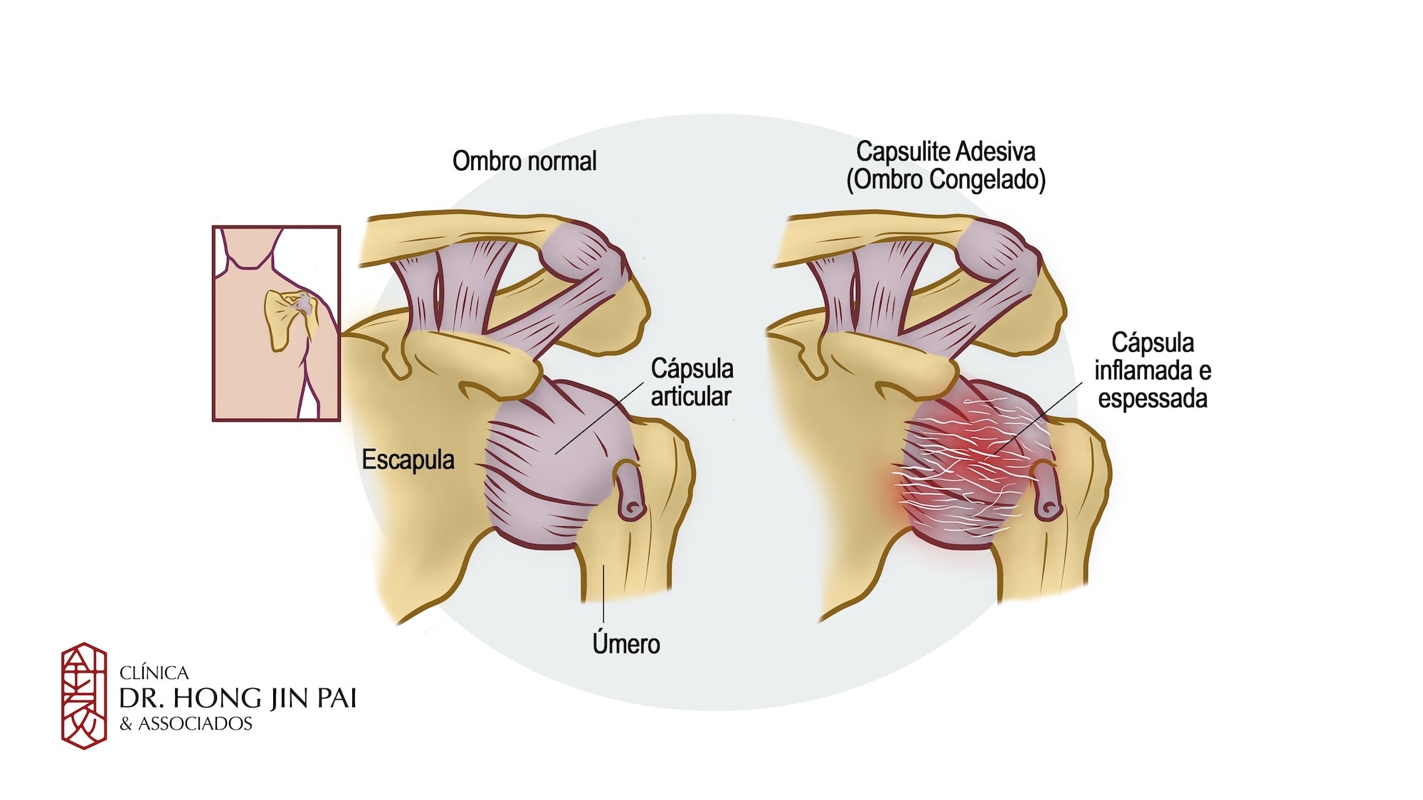 Capsulite Adesiva: ombro congelado - Clínica Dr. Hong Jin Pai - Dor ...