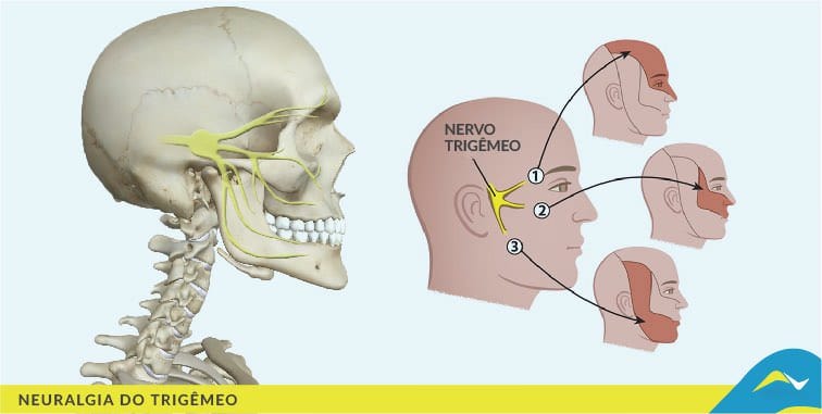 O que é Neuralgia do trigêmeo? O que causa a Neuralgia do trigêmeo ...