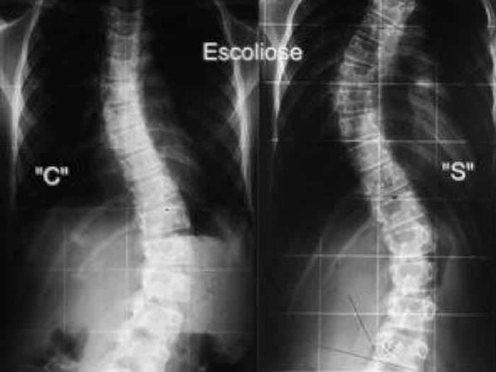 Escoliose – Causas, sintomas e tratamentos | Clínica Dr. Hong Jin Pai ...