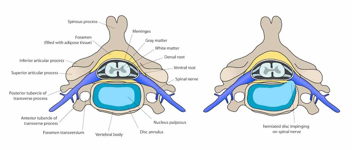 Protrusão discal: sintomas e tratamento | Clínica Dr. Hong Jin Pai ...