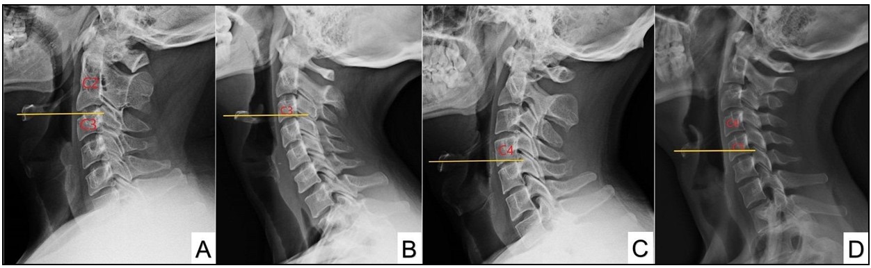 Retificação da Lordose Cervical: O Que é e Como Diagnosticar - Clínica ...